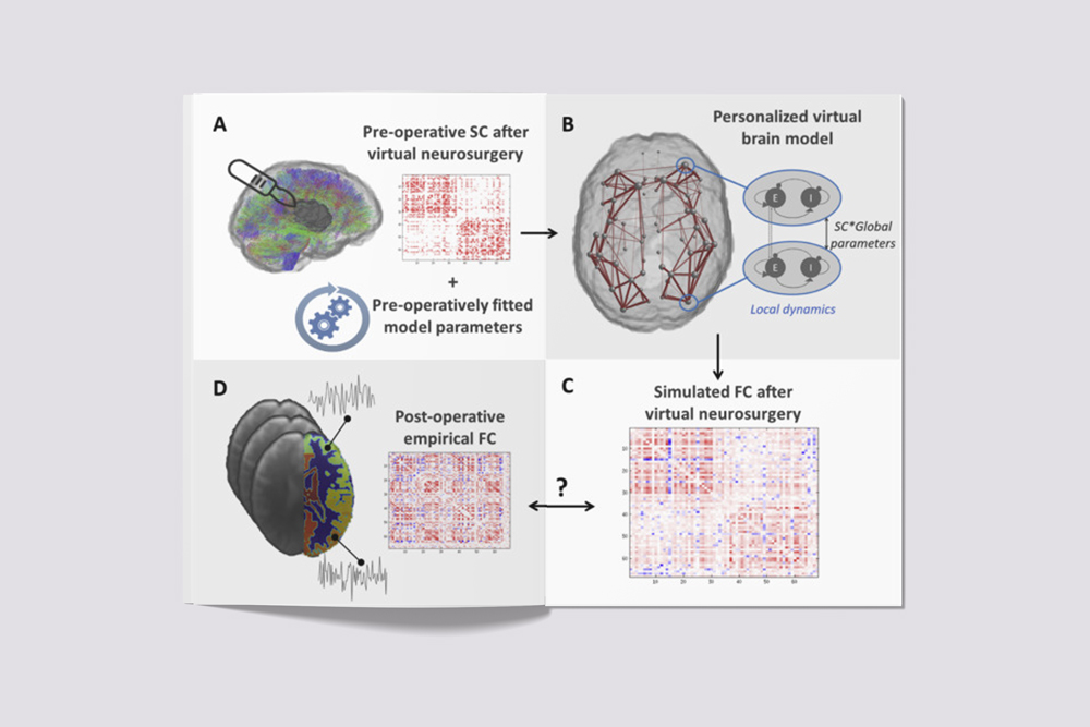 Modeling Brain Dynamics After Tumor Resection Using The Virtual Brain 